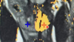 Prostate Laser Treatment & BPH | Prostate Laser Center