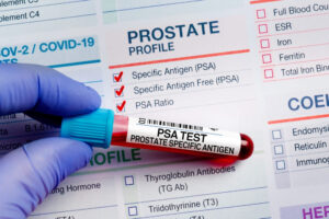 Stress And High PSA Levels | Prostate Laser Center