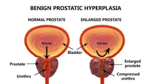 What Is The Best Treatment For Enlarged Prostate?